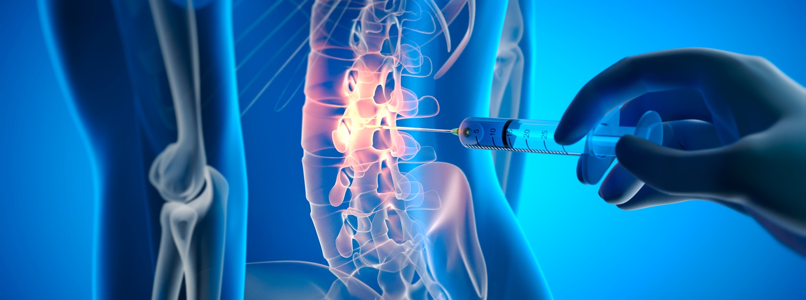Facet Injections | Rapid, Safe & Non-Surgical Pain Relief