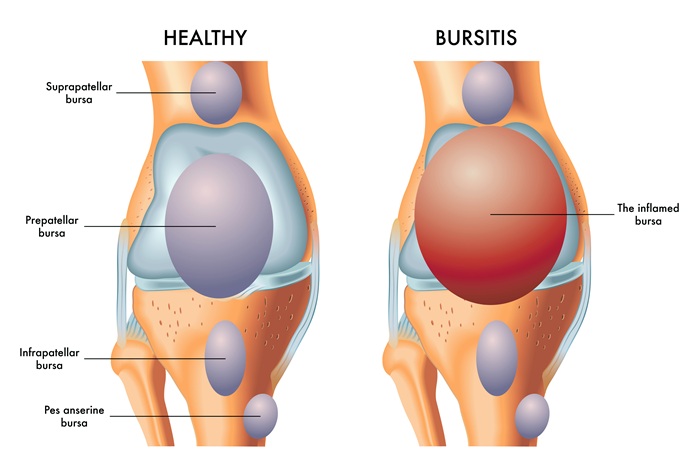 Knee Bursitis Symptoms Causes Holistic Treatment Options