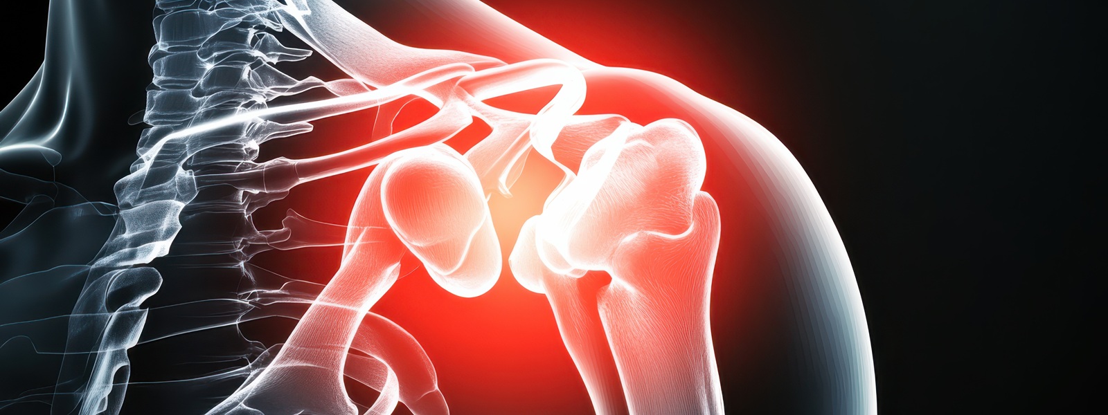 Dive Into Adhesive Capsulitis (Frozen Shoulder)